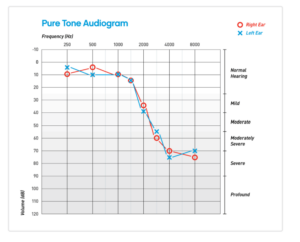 Bone Conduction Test for Hearing Loss | What it is, How it Works