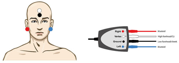 Auditory Brainstem Response: An Overview | Sound Hearing