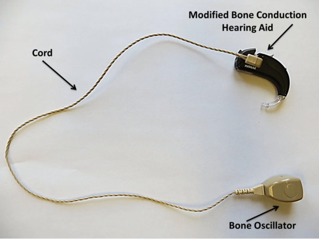 Bone Conduction Test | What it is, When it's Used | Sound Hearing